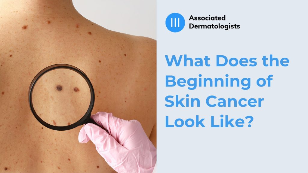 What Does The Beginning Of Skin Cancer Look Like? - Associated ...