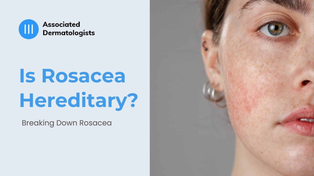 Is Rosacea Hereditary
