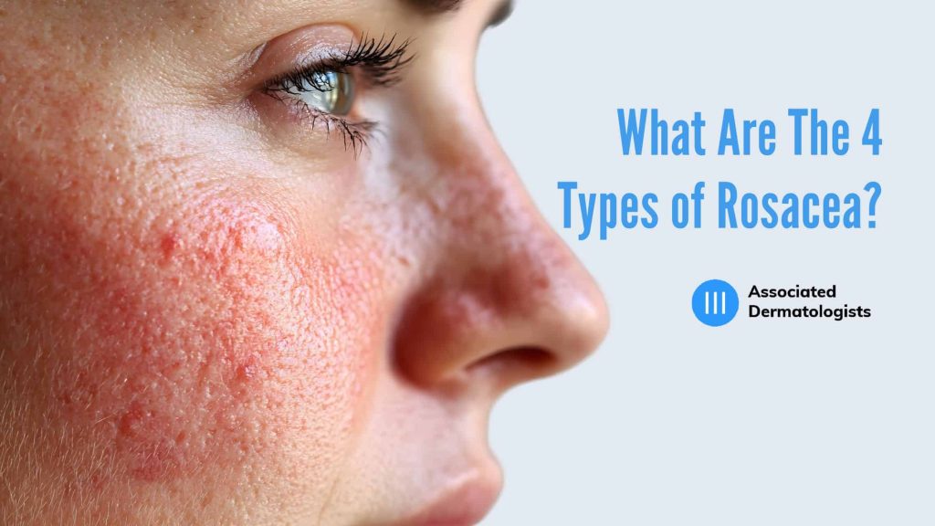 What Are The 4 Types Of Rosacea?