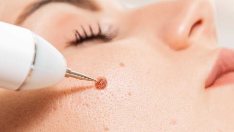 How Much Does Wart Removal Cost