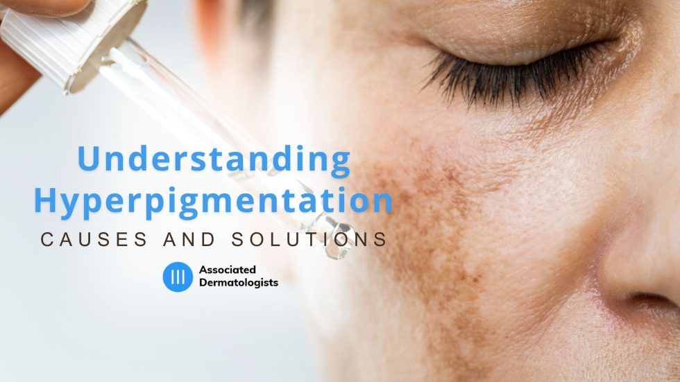 Understanding Hyperpigmentation: Causes And Solutions